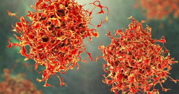EU facing one million undiagnosed cancer cases