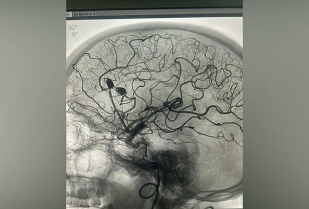 Jaipur's Eternal Hospital rare feat in Neurointervention - Endovascular ...