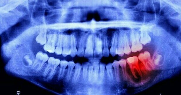 Scientists Begin Human Trials for Tooth-Regrowing Drug