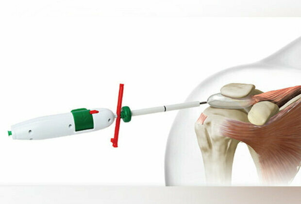 Stryker Launches InSpace, a First-of-Its-Kind Biodegradable Subacromial ...