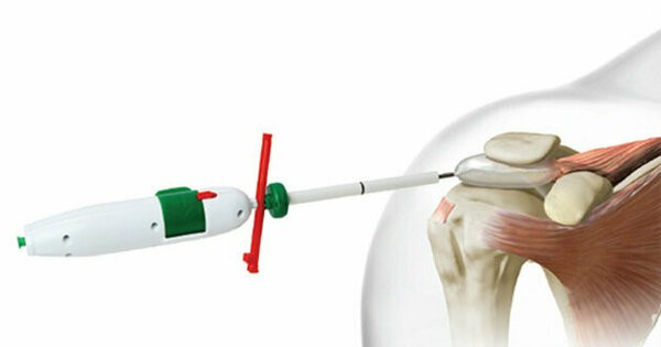 Stryker Launches InSpace, a First-of-Its-Kind Biodegradable Subacromial ...