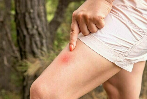 Mosquito, tick or flea? How to avoid, identify and treat insect bites ...