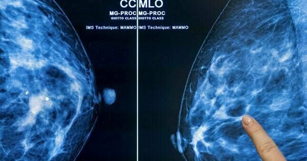 Breast density and mammograms: New FDA rule will ensure all women have ...