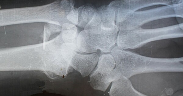 AI technology used to detect fractures