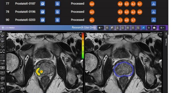 NHS AI trial to diagnose prostate cancer faster