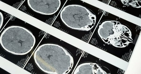 Cellular housekeeping process implicated in fatal neurological disorder ...