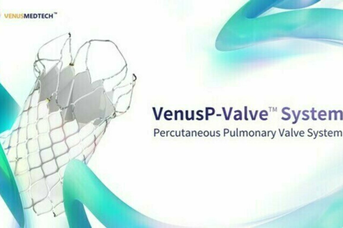 Venus Medtech VenusP-Valve transcatheter pulmonic valve replacement ...